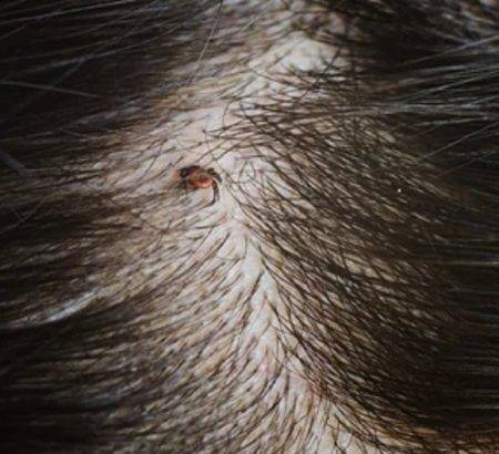 5 Effective Ways to Get Rid of Bird Mites in Human Hair